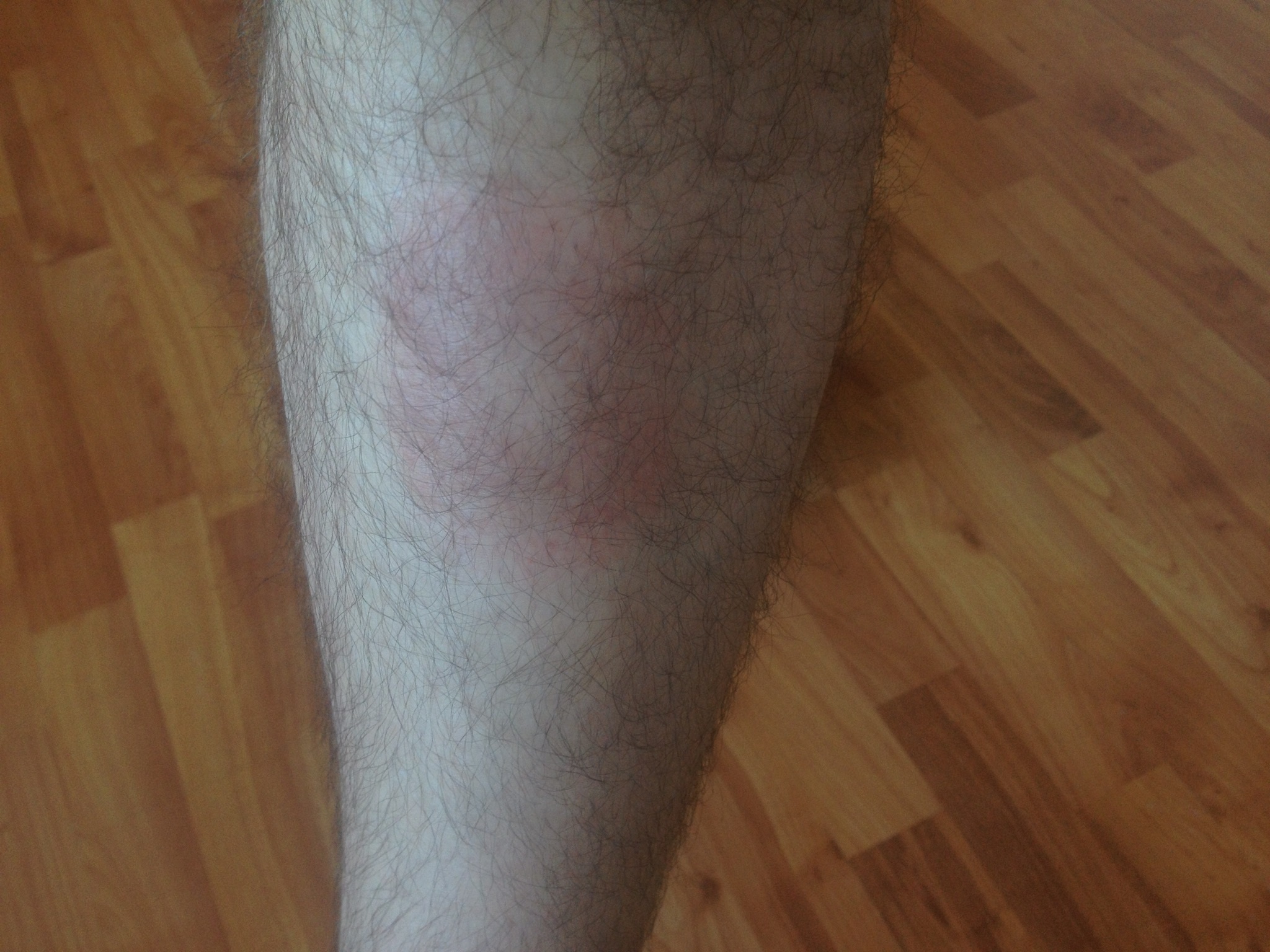 Vreemde insectenbeet - Algemene zaken - GoT